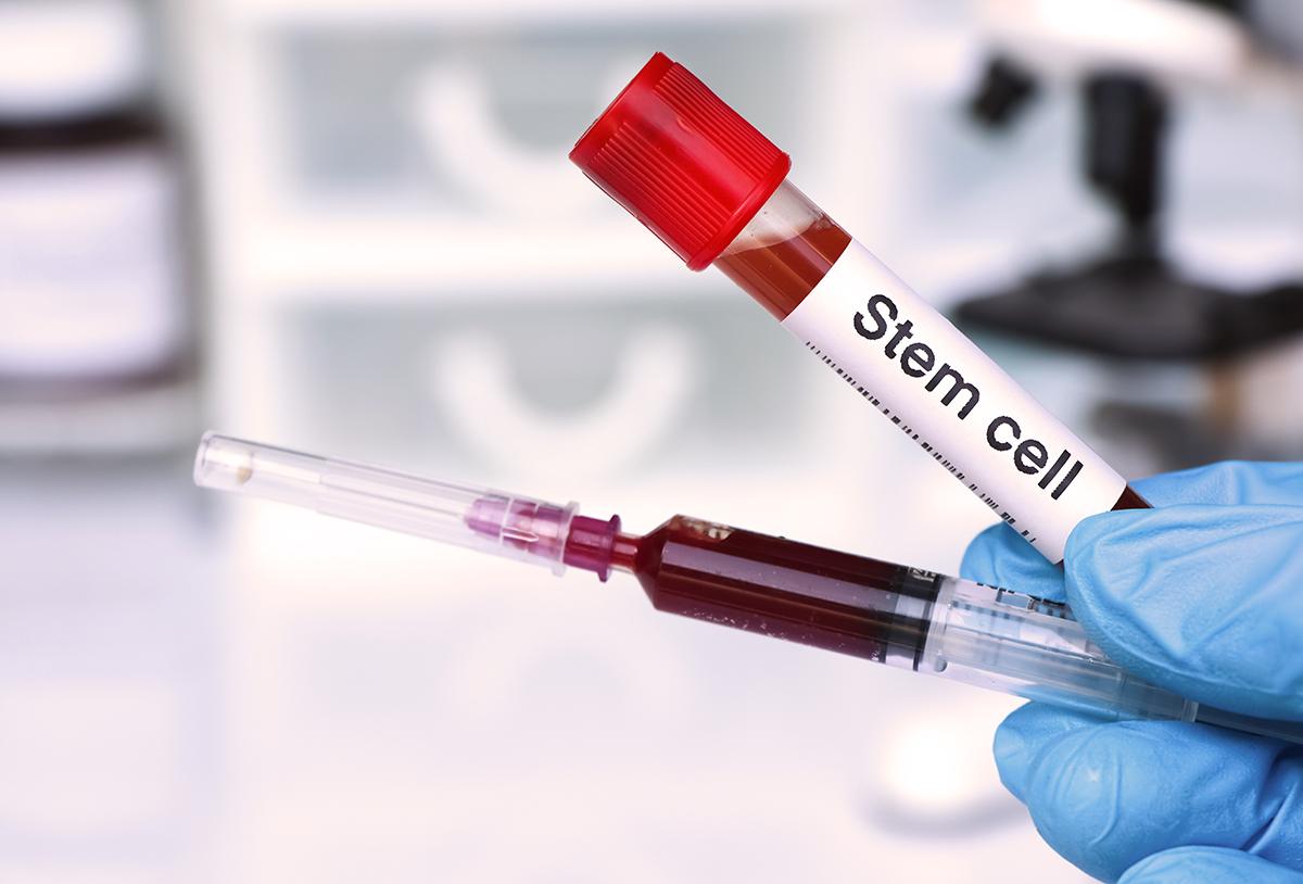 Ovarian Rejuvenation: PRP, Stem Cells and “Dual SEGOVA” Approach - Segova